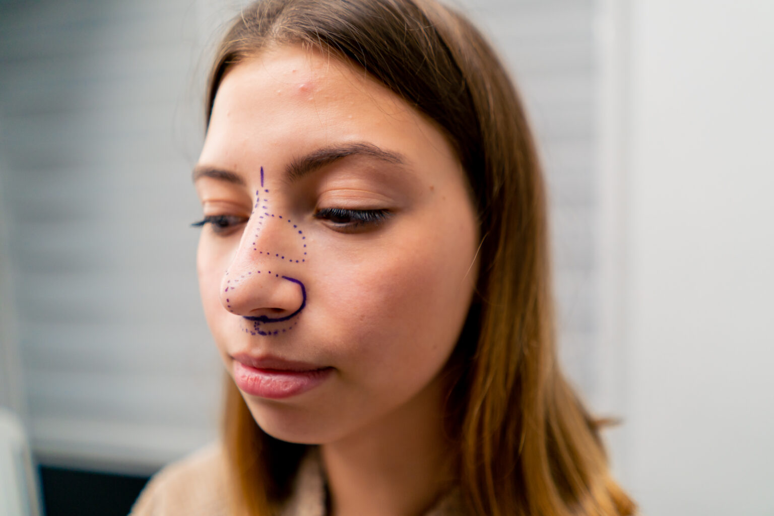 Balloon Sinuplasty - Glatz Group Sinus Relief Specialists